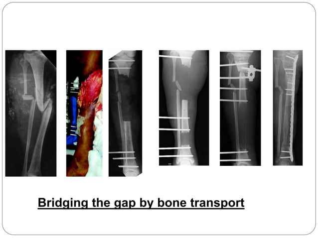 open injury and open fracture management | PPT