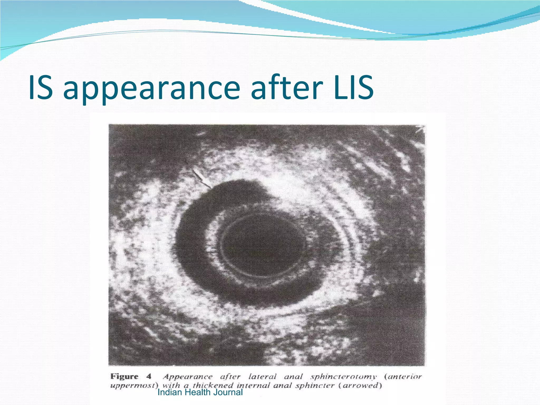 Open lateral internal sphincterotomy | PPT