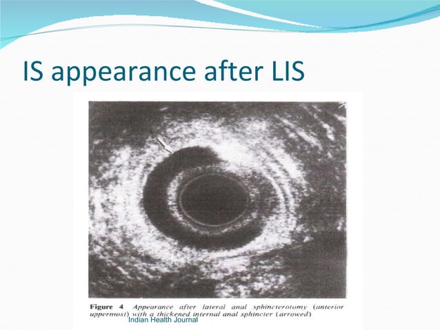 Open lateral internal sphincterotomy | PPT | Digestive Disorders ...