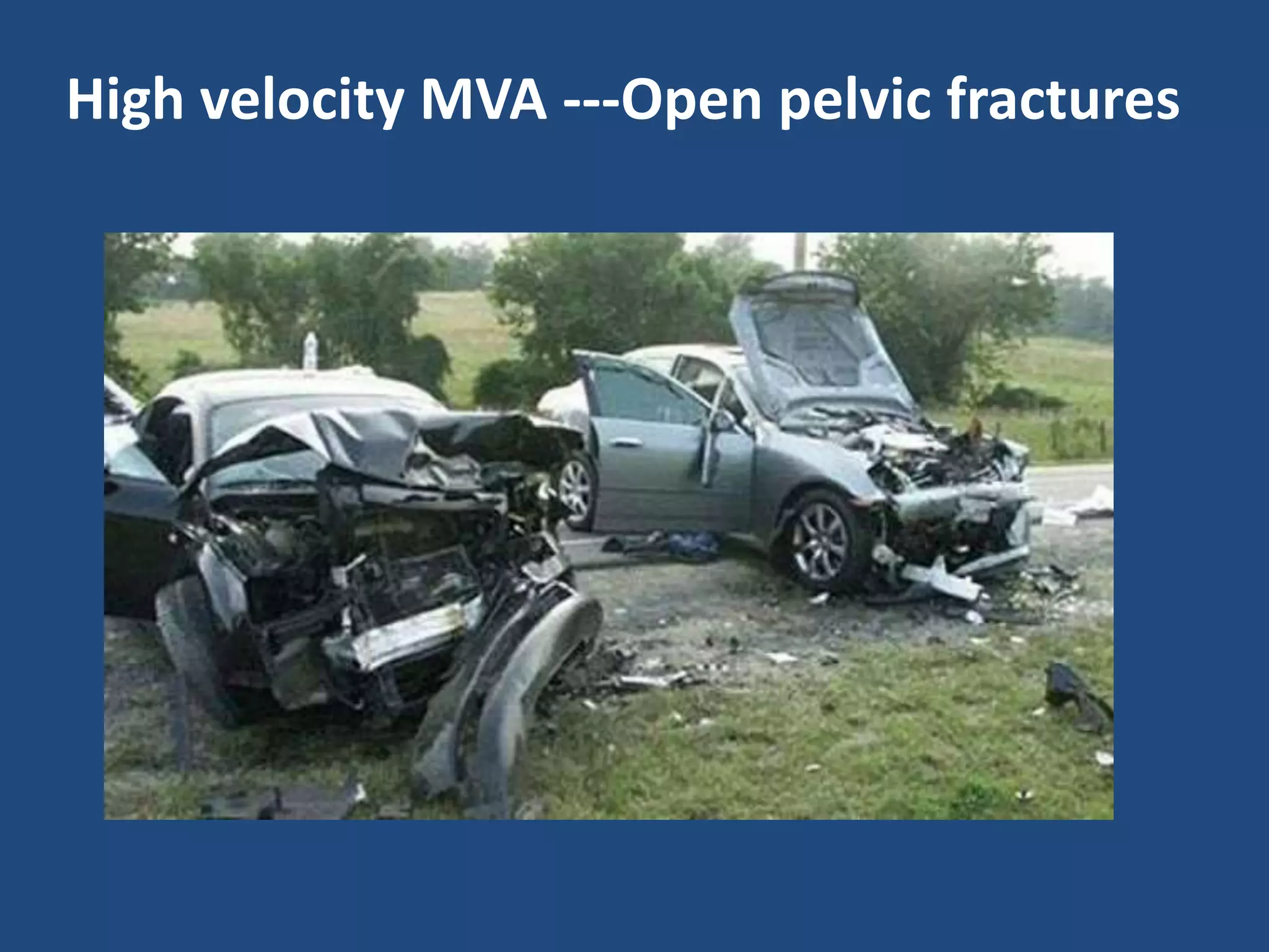 Open pelvic trauma and associated injury management | PPTX
