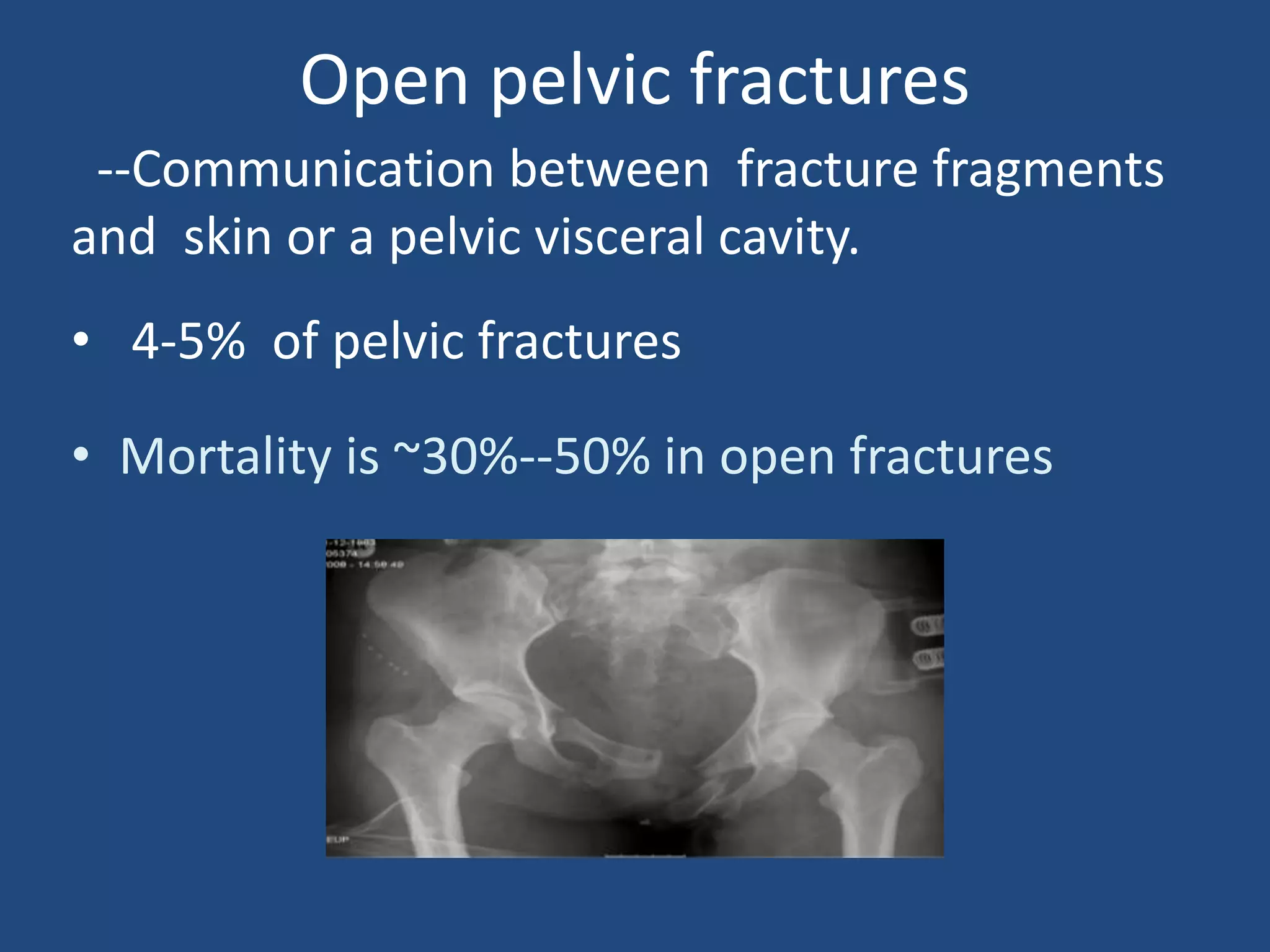Open pelvic trauma and associated injury management | PPTX