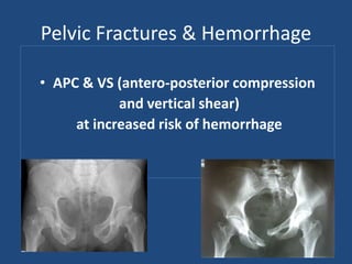 Open pelvic trauma and associated injury management | PPTX