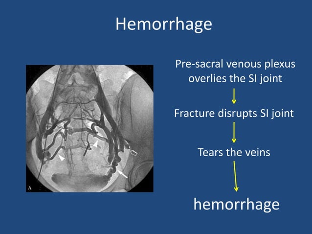 Open pelvic trauma and associated injury management | PPTX | Death ...
