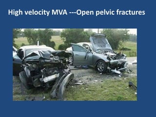 Open pelvic trauma and associated injury management | PPTX