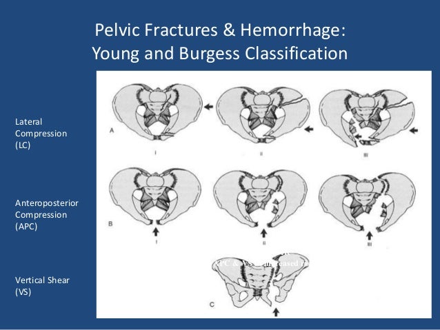 Open pelvic trauma and associated injury management