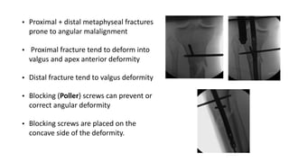 Tibia shaft fracture and fibula shaft fracture | PDF