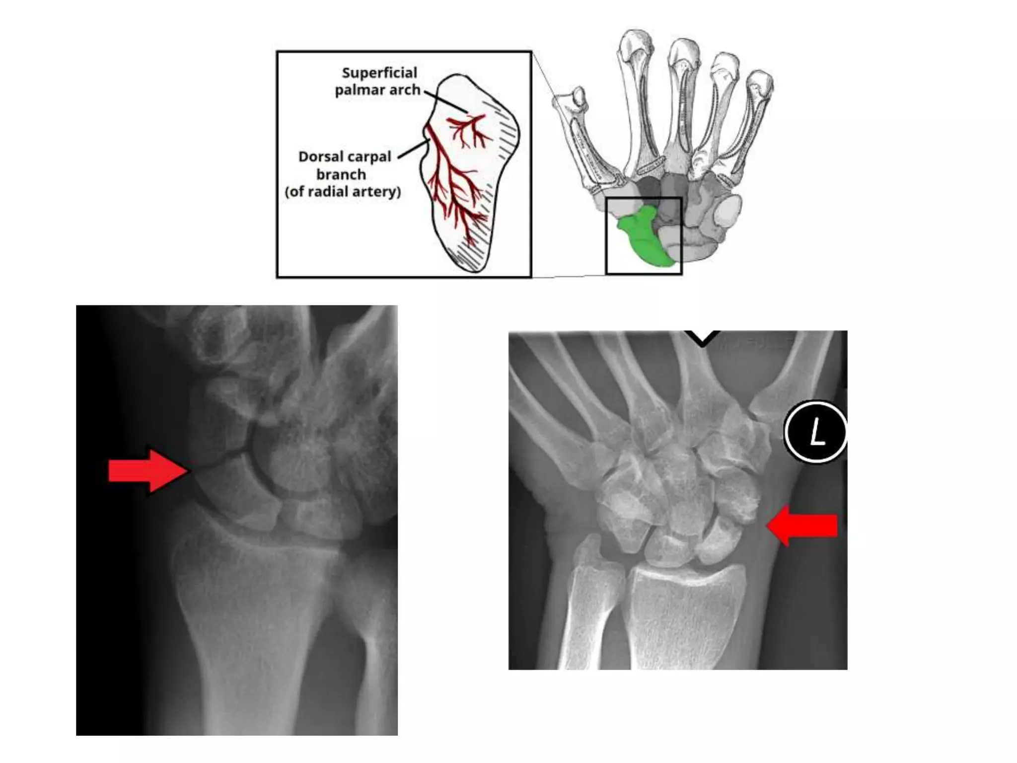 Open Reduction of carpal bone fractures | PPTX