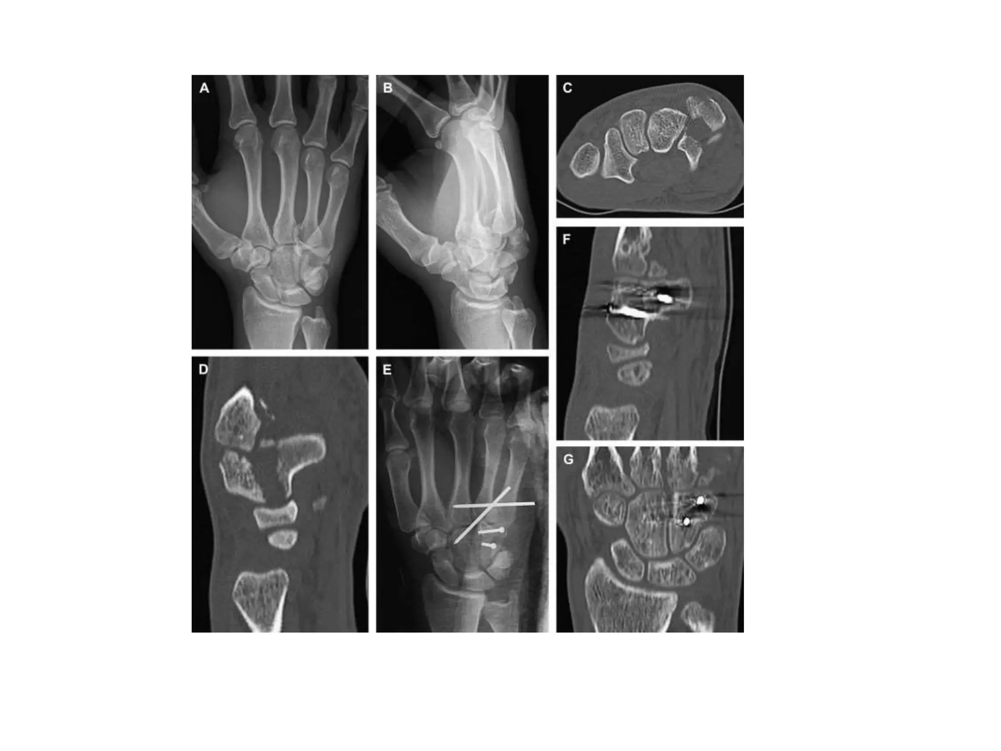 Open Reduction of carpal bone fractures | PPTX