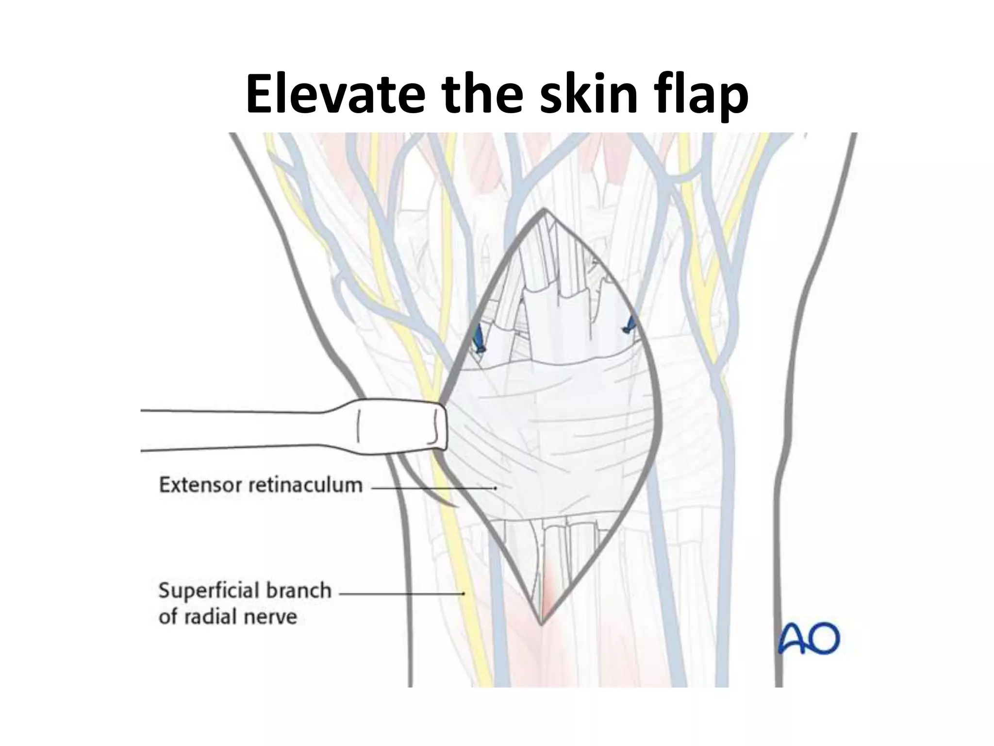 Open Reduction of carpal bone fractures | PPTX