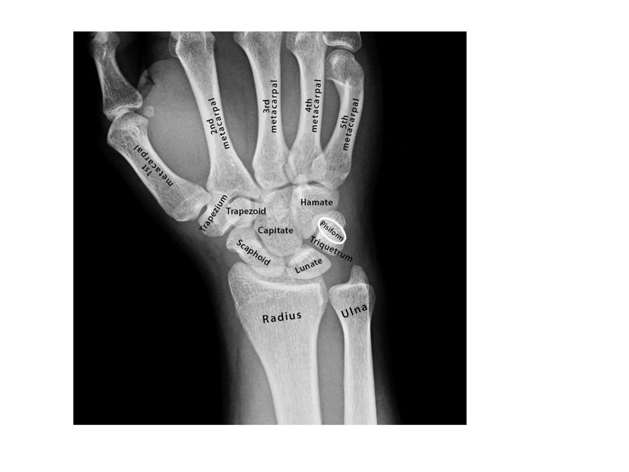 Open Reduction of carpal bone fractures | PPTX