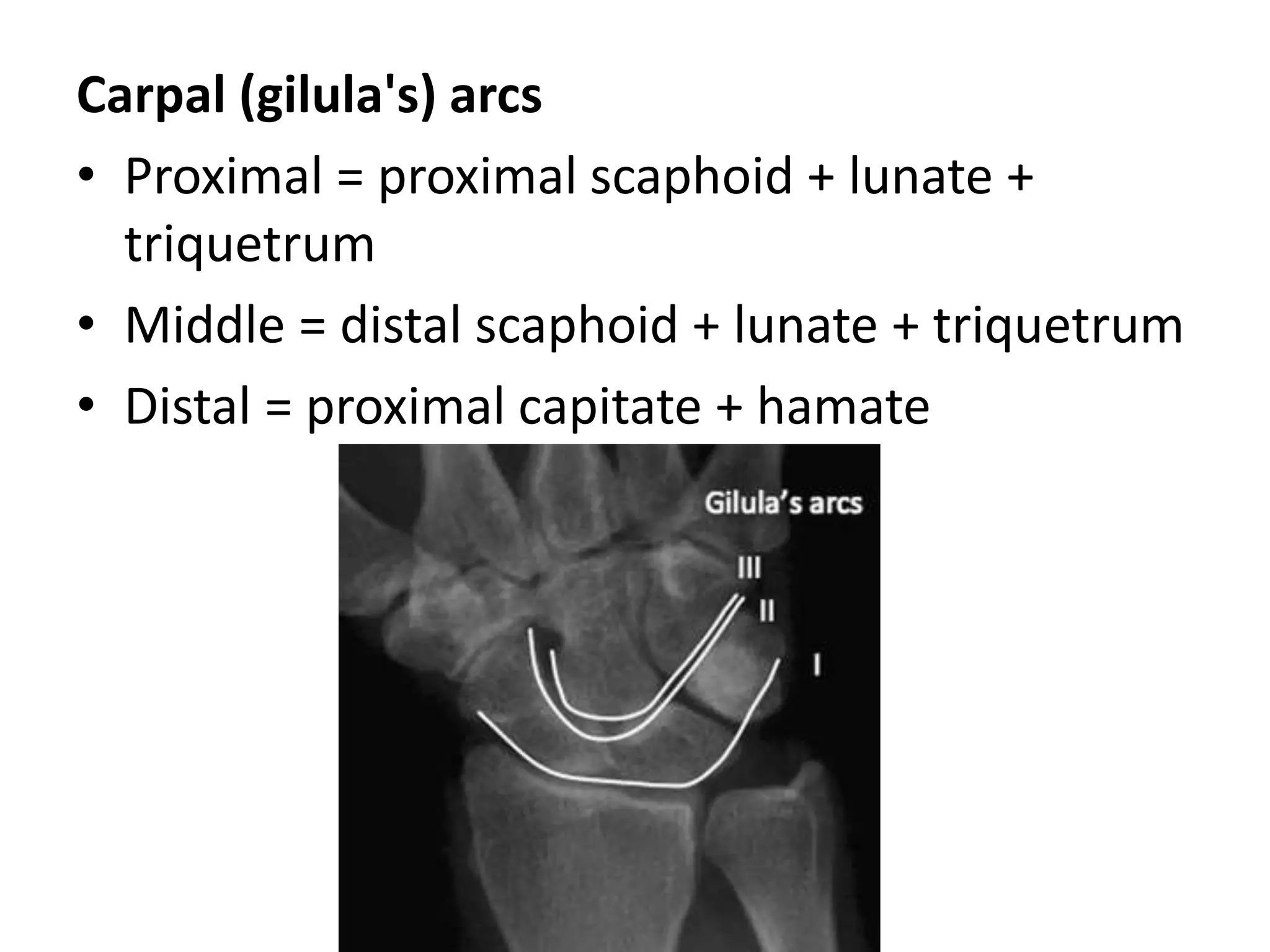 Open Reduction of carpal bone fractures | PPTX