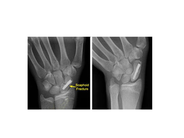 Open Reduction of carpal bone fractures | PPTX | Death, Injury, or ...