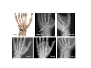 Open Reduction of carpal bone fractures | PPTX
