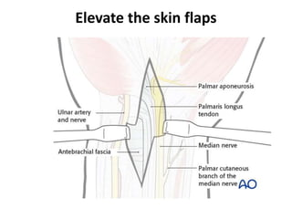 Open Reduction of carpal bone fractures | PPTX