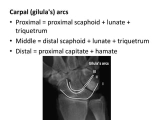 Open Reduction of carpal bone fractures | PPTX