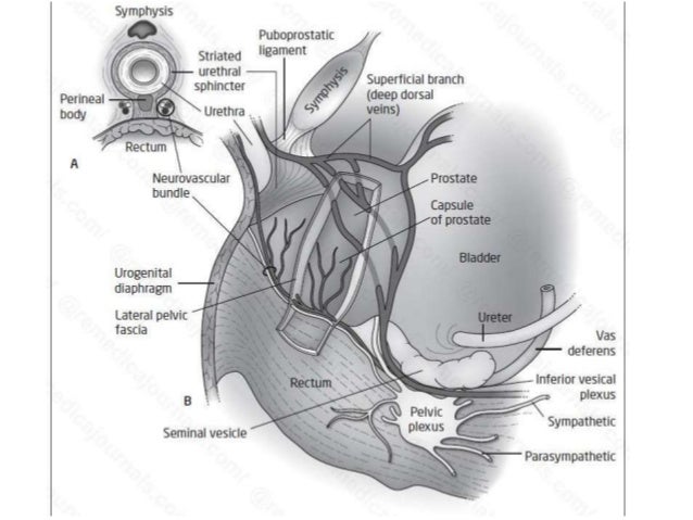 Open Retropubic Prostatectomy