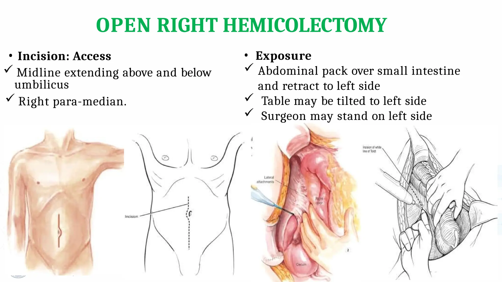 OPEN RIGHT HEMICOLECTOMY - General Surgery Course.pptx