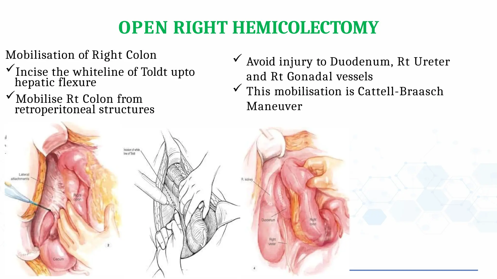 OPEN RIGHT HEMICOLECTOMY - General Surgery Course.pptx