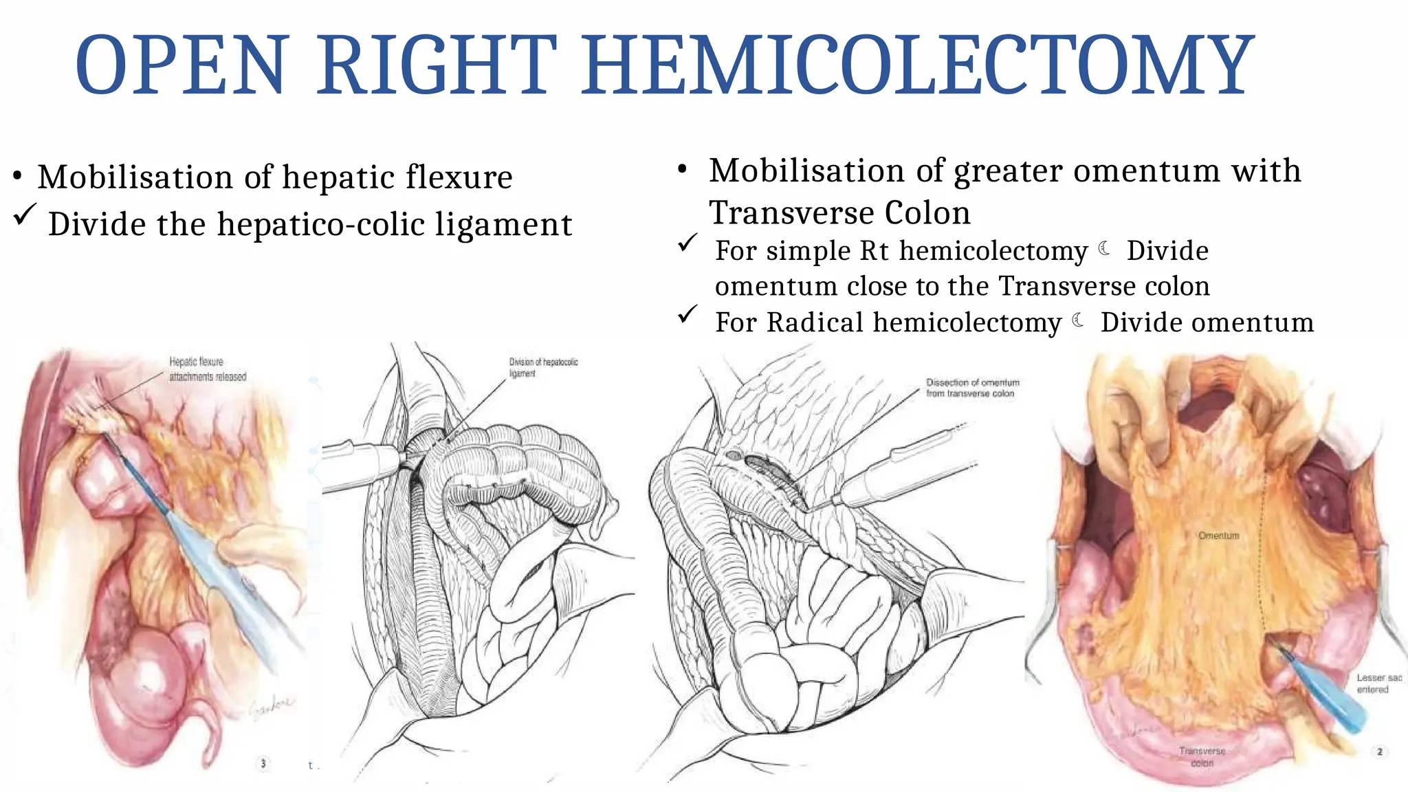 OPEN RIGHT HEMICOLECTOMY - General Surgery Course.pptx