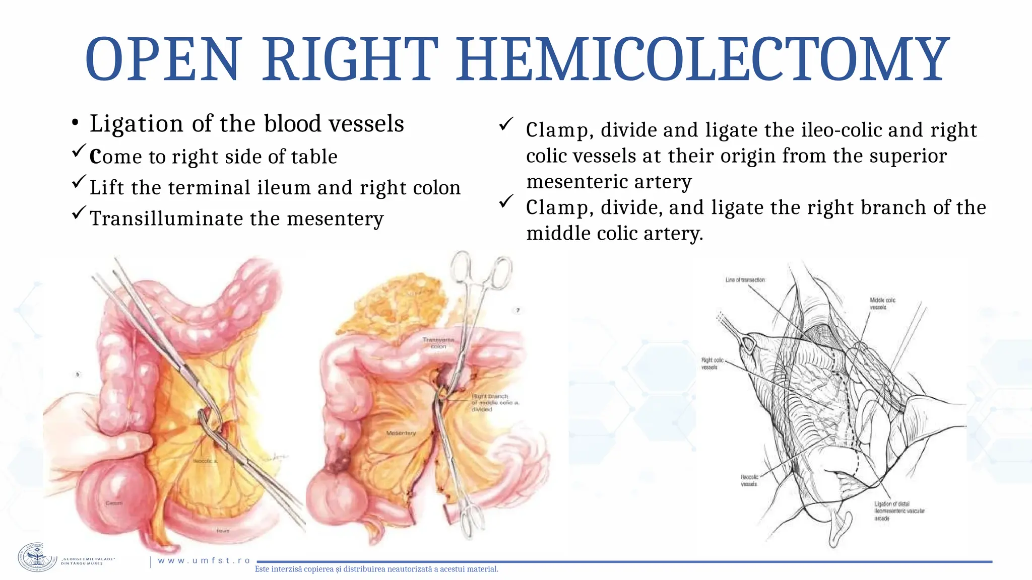 OPEN RIGHT HEMICOLECTOMY - General Surgery Course.pptx