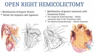 OPEN RIGHT HEMICOLECTOMY - General Surgery Course.pptx