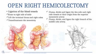 OPEN RIGHT HEMICOLECTOMY - General Surgery Course.pptx
