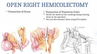 OPEN RIGHT HEMICOLECTOMY - General Surgery Course.pptx