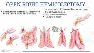 OPEN RIGHT HEMICOLECTOMY - General Surgery Course.pptx