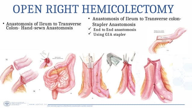 OPEN RIGHT HEMICOLECTOMY - General Surgery Course.pptx