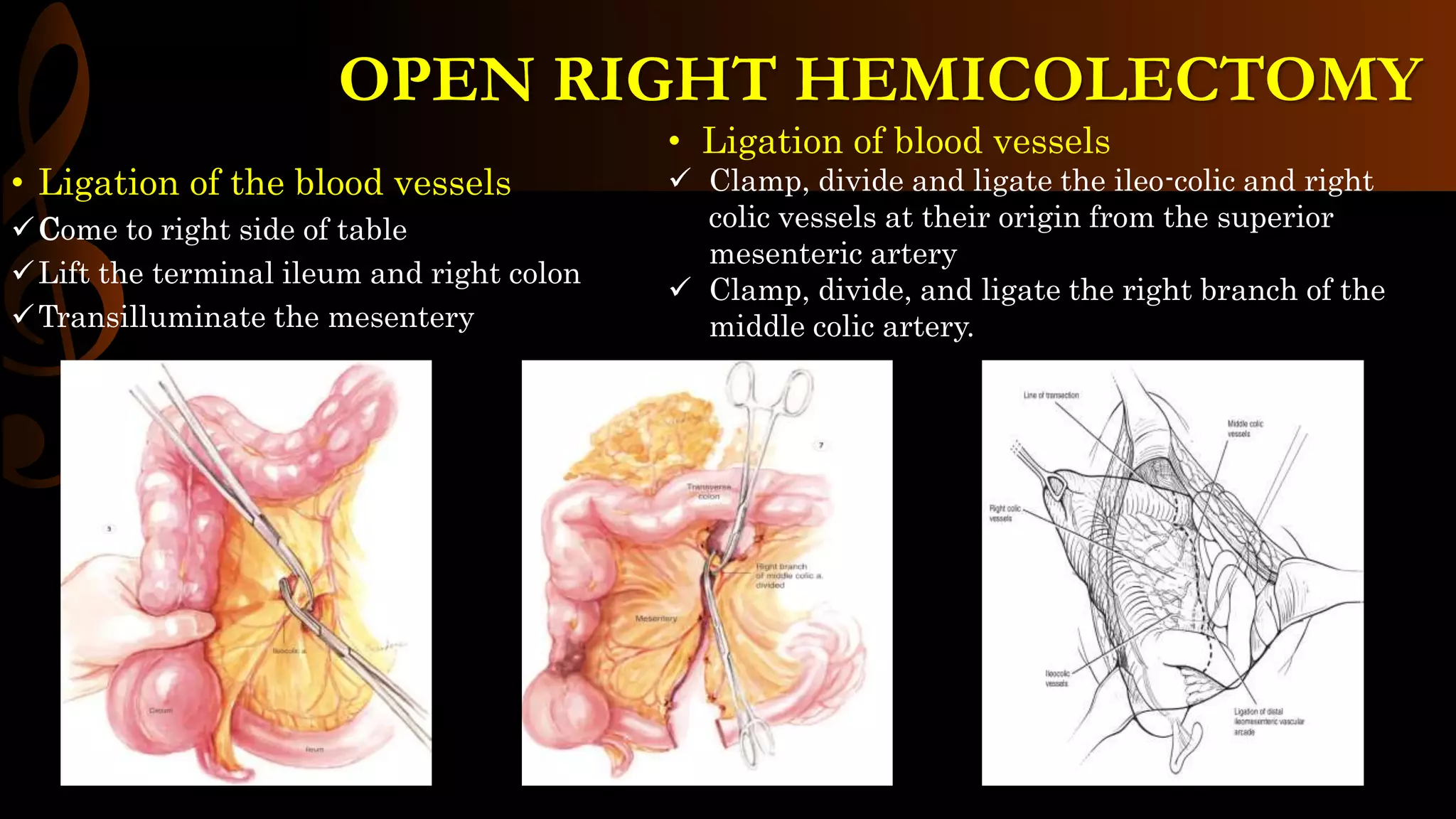 Open right hemicolectomy/ step by step/ operative surgery | PPTX