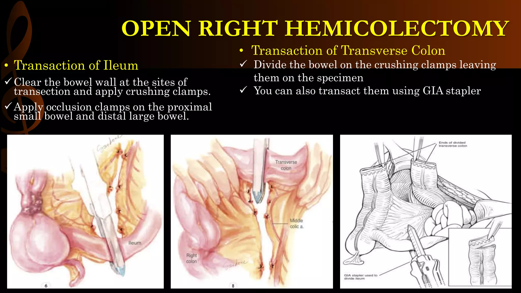 Open right hemicolectomy/ step by step/ operative surgery | PPTX