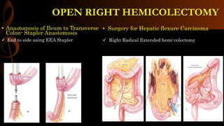 Open right hemicolectomy/ step by step/ operative surgery | PPTX
