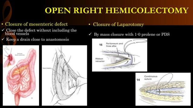 Open right hemicolectomy/ step by step/ operative surgery | PPTX | Digestive Disorders ...