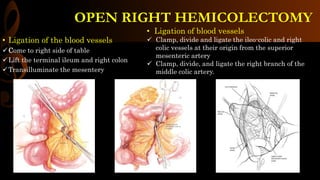 Open right hemicolectomy/ step by step/ operative surgery | PPTX