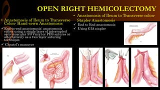 Open right hemicolectomy/ step by step/ operative surgery | PPTX