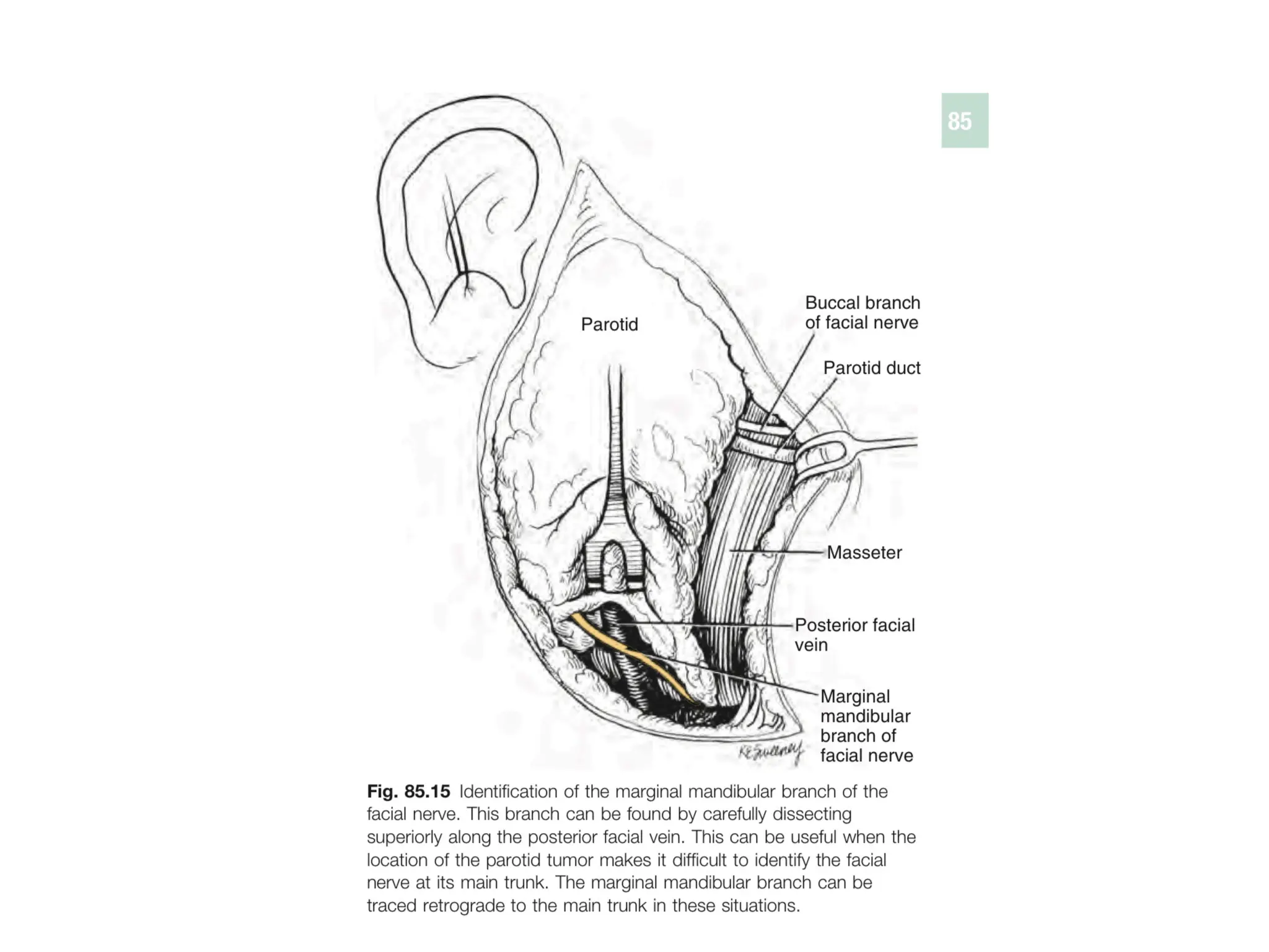 Parotidectomy superficial orlhns technique | PDF