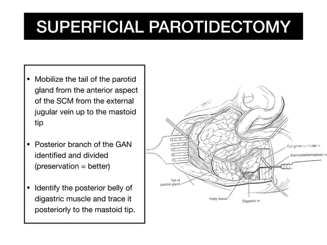 Parotidectomy superficial orlhns technique | PPT