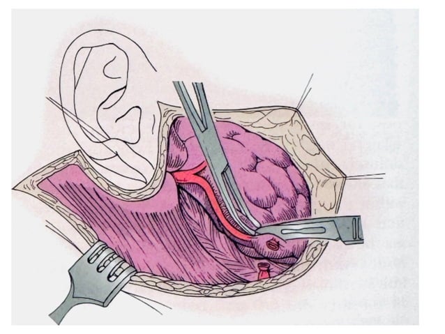 Parotidectomy superficial orlhns technique | PPT