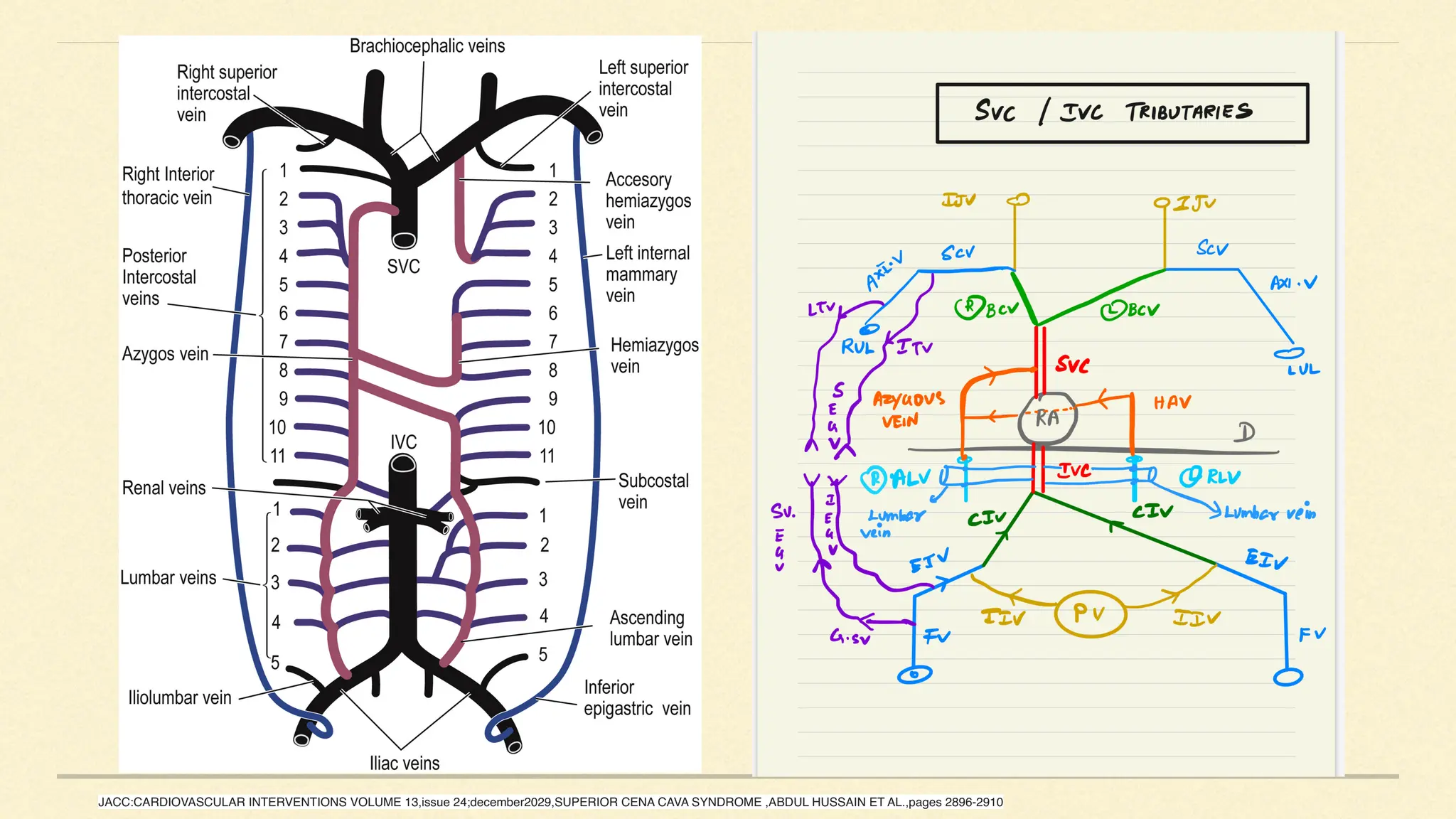 Svc syndrome.pdf