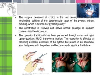 Stenosis Hipertropic pylorus Open versus laparoscopic pyloromyotomy | PPT