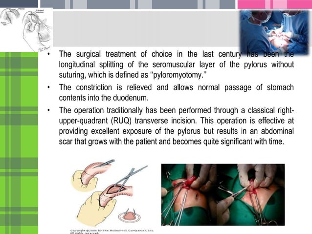 Stenosis Hipertropic pylorus Open versus laparoscopic pyloromyotomy | PPT