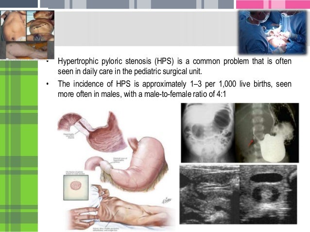 Laparoscopic Pyloromyotomy Surgery Alternative Knife