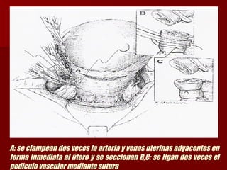 OPERACION CESAREA E HISTERECTOMIA OBSTETRICA | PPT