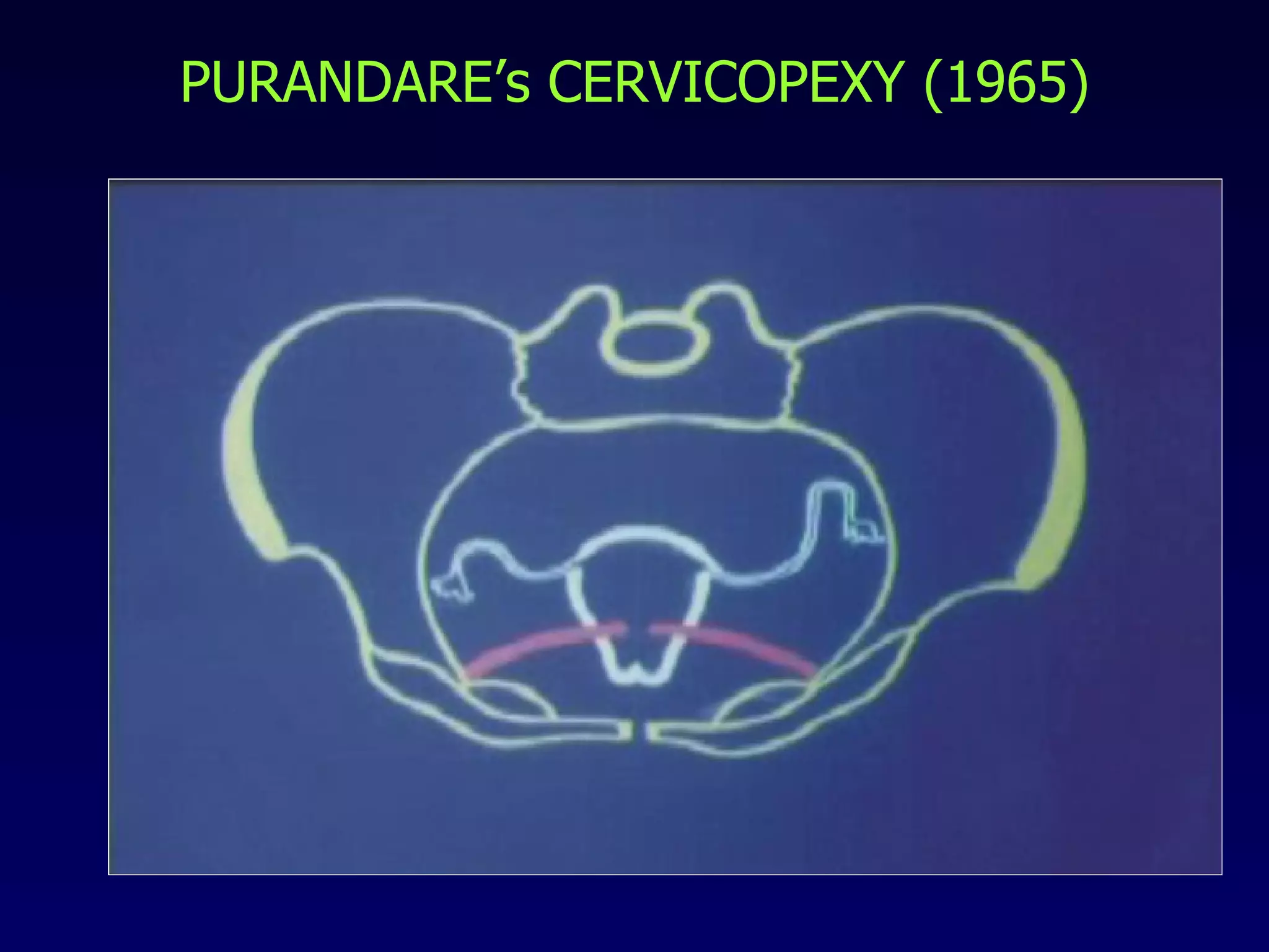 OPERATIONS FOR NULLIPAROUS PROLAPSE AND VAGINAL VAULT PROLAPSE, Mob ...