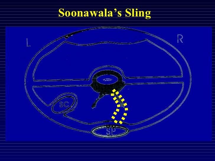Uterosacral Ligament Plication