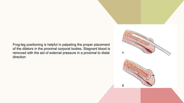 OPERATION TECHNIQUE about priaspsm in human | PPTX