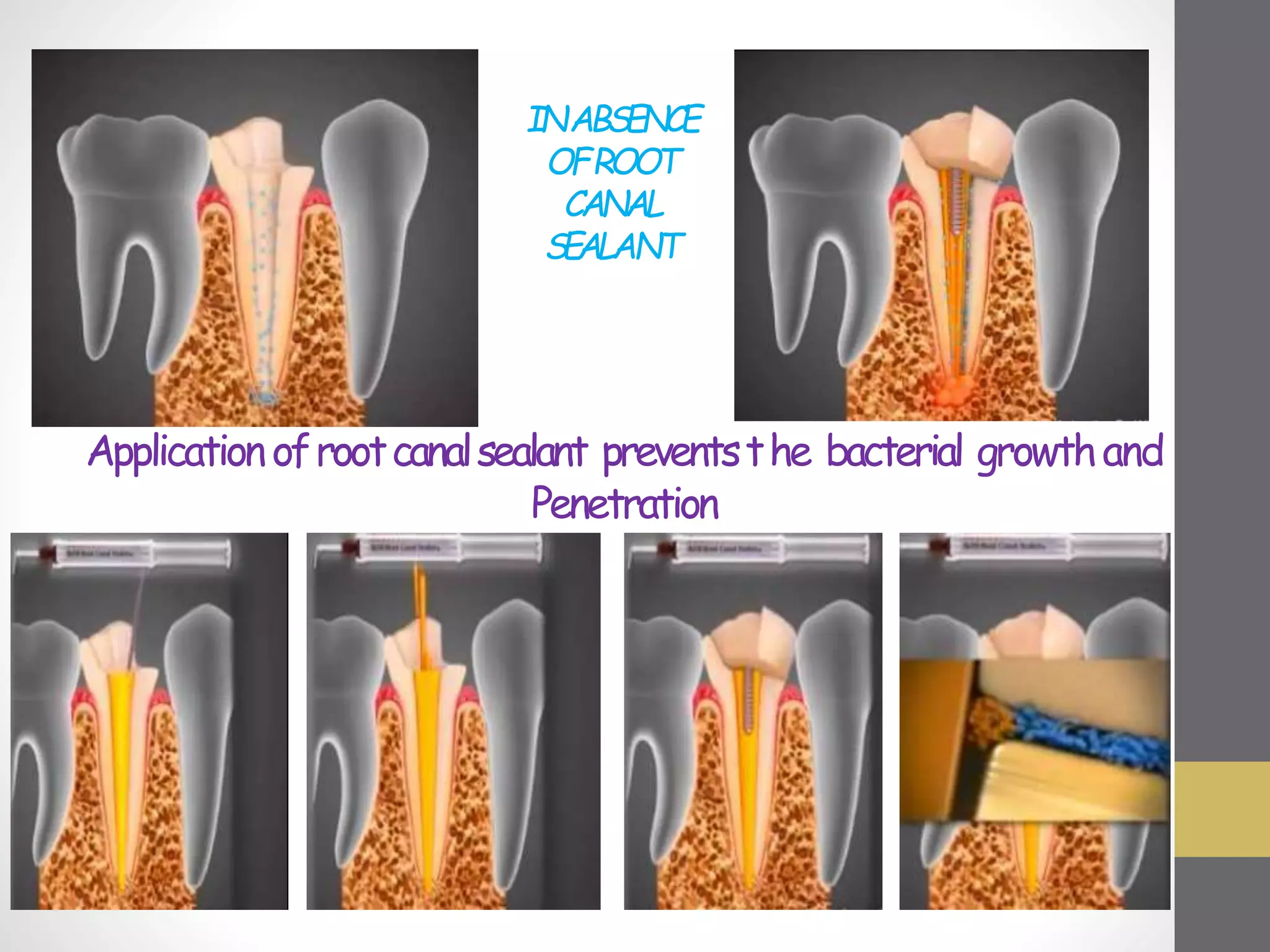 ROOT CANAL SEALERS | PPT