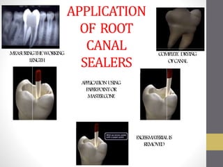 ROOT CANAL SEALERS | PPT