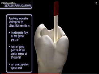 ROOT CANAL SEALERS | PPT