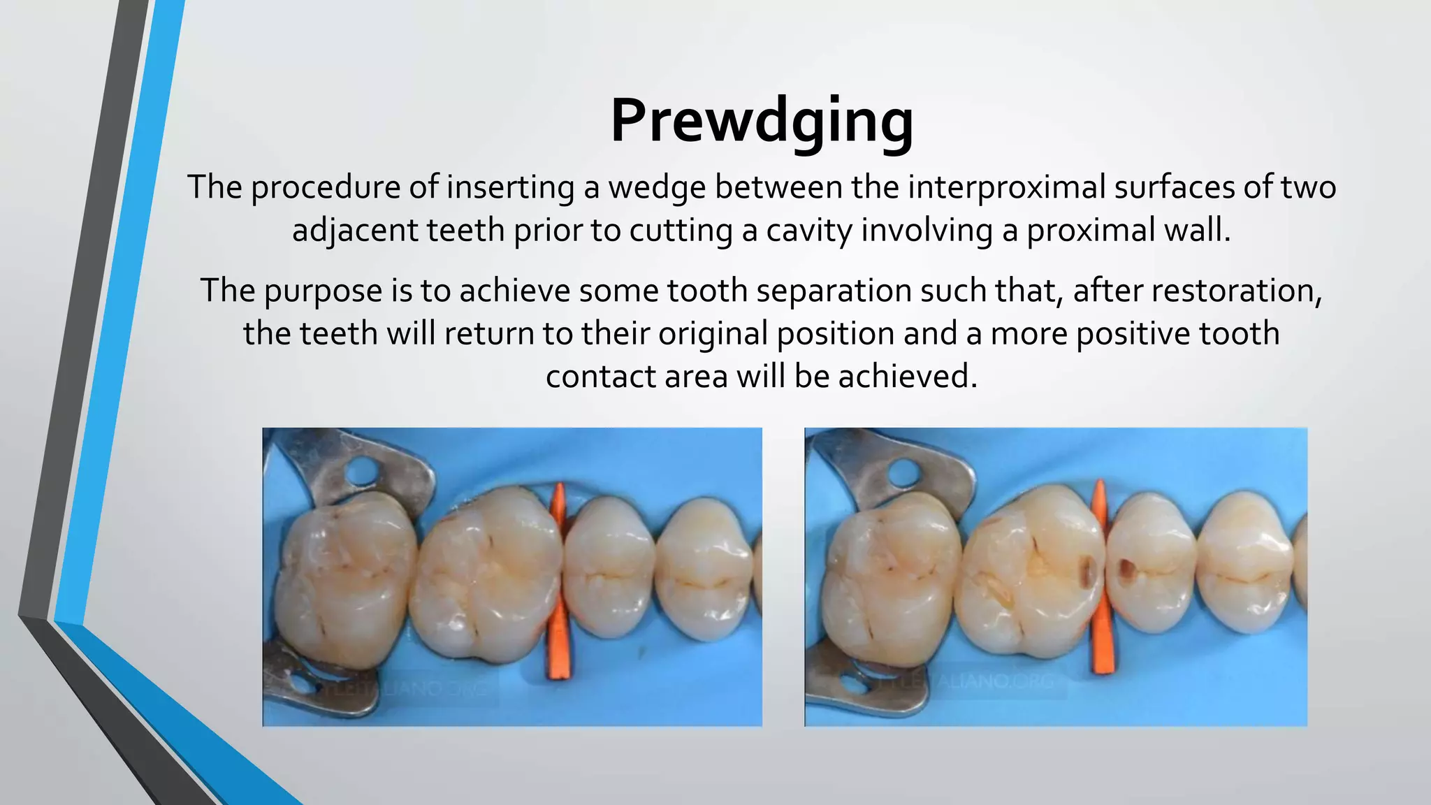 wedge and their technique and prewedging | PPTX